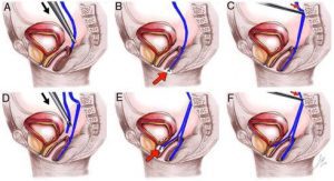 Colposacropexia Laparoscópica O Robótica Clínica Urosalud